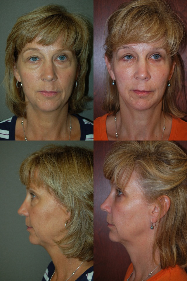 Breast Procedures Gallery | Renaissance Plastic Surgery