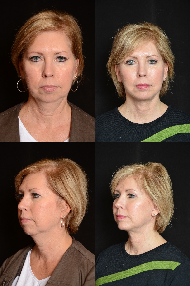 Facial Augmentation (Implants) Before & After Photos | Renaissance ...