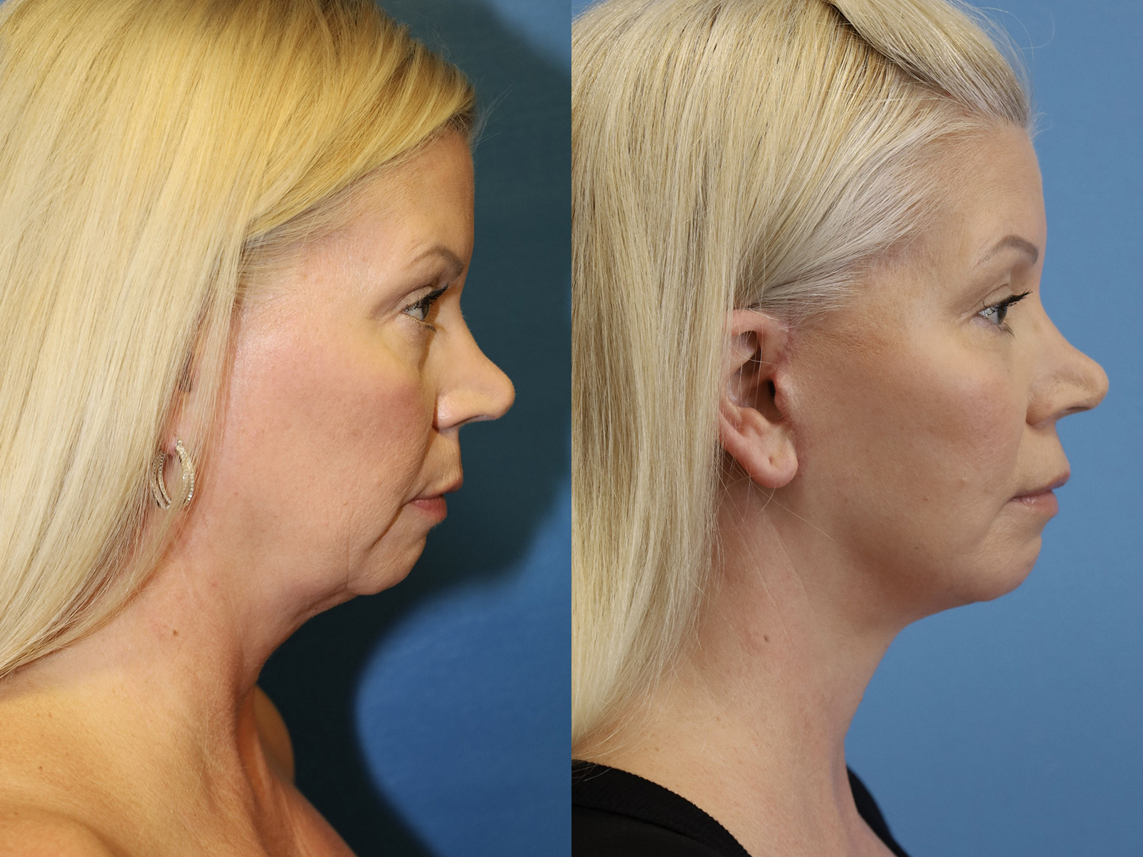 Before & After Rhytidectomy Photos | Dr. Stefani